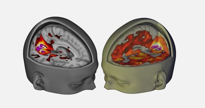 Una nueva técnica de neuroimagen muestra los efectos del LSD en el cerebro | SinEmbargo MX